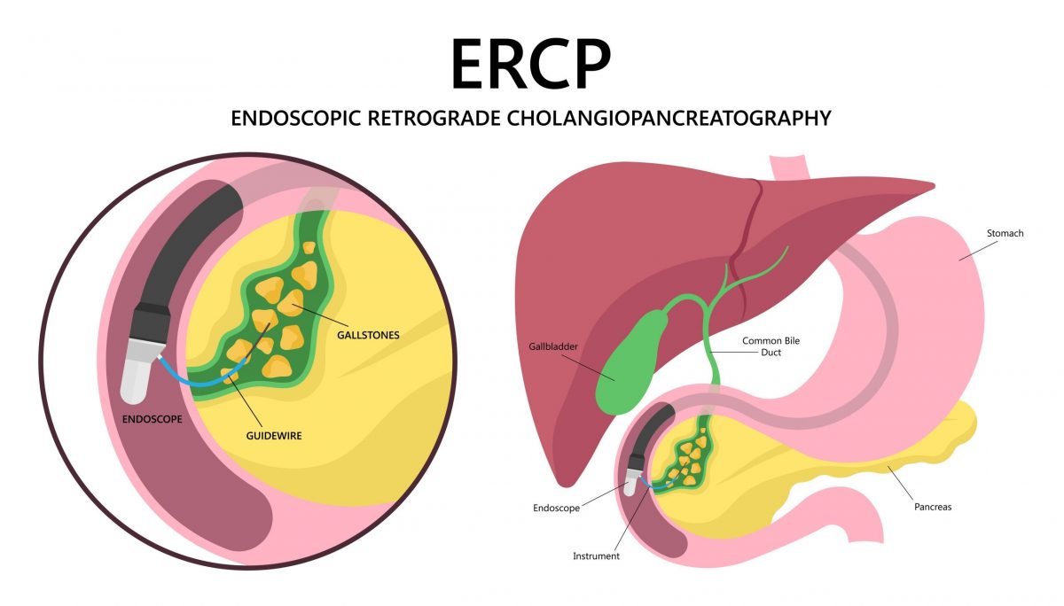 New Sedation Findings: ERCP for Bile and Pancreatic Ducts - EndoProMag.com